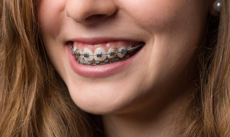 What Are Braces and How Do They Work?