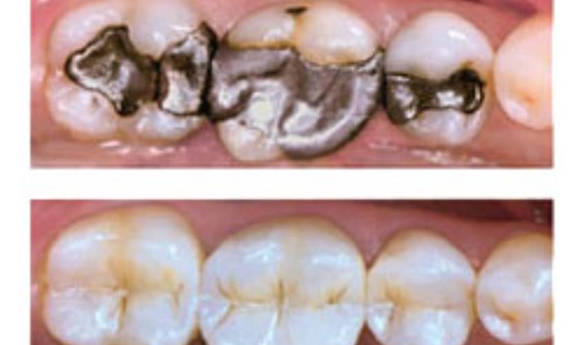 Dental Filling: Types, Procedure and Cost