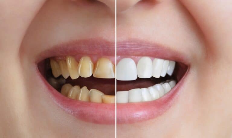 11 Ways To Remove Coffee Stains From Your Teeth