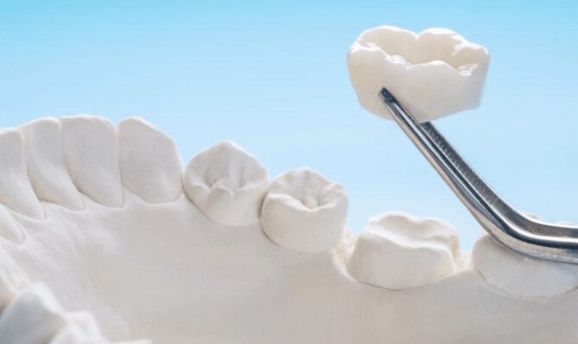 Discover the Best Porcelain Crowns for Your Smile